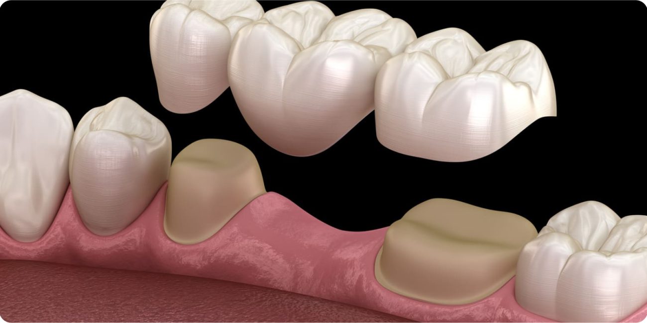 Pont dentaire - Dr. Wisdom